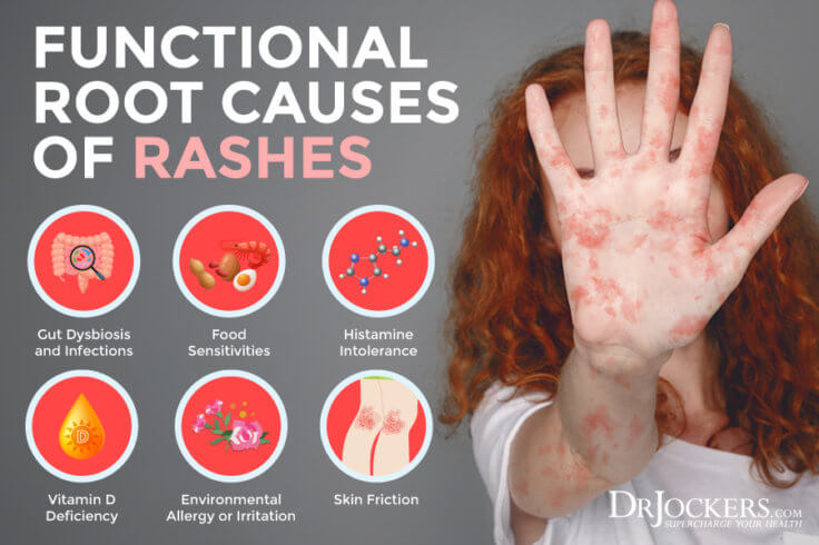 Skin Rashes: Symptoms, Causes and Natural Support Strategies