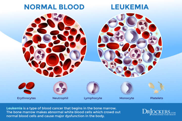 Leukemia: Symptoms, Causes, and Support Strategies - DrJockers.com