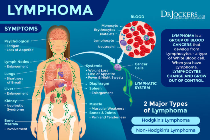 Lymphoma: Symptoms, Causes, and Support Strategies - DrJockers.com