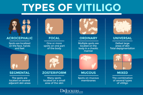 Vitiligo: Symptoms, Causes, and Support Strategies