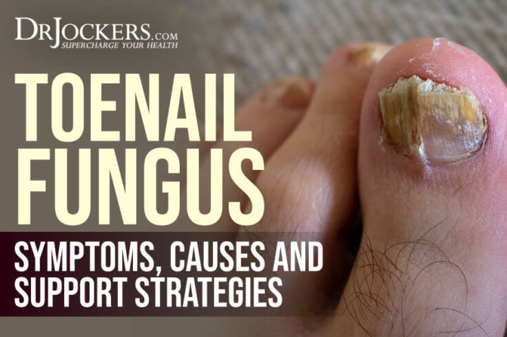 Toenail Fungus: Symptoms, Causes and Support Strategies