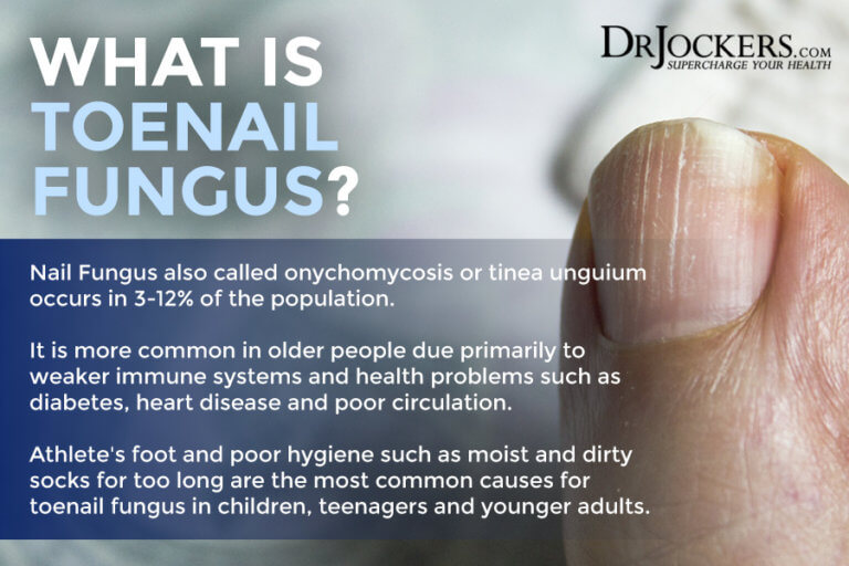 Toenail Fungus: Symptoms, Causes and Support Strategies