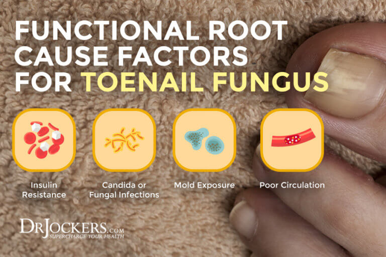 Toenail Fungus: Symptoms, Causes and Support Strategies
