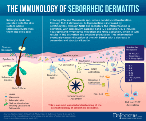 Dandruff: Root Causes and Support Strategies - DrJockers.com