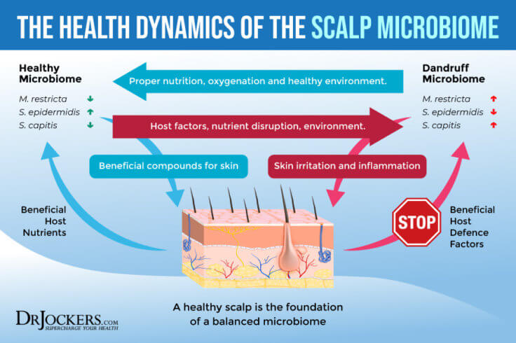 Dandruff: Root Causes and Support Strategies - DrJockers.com