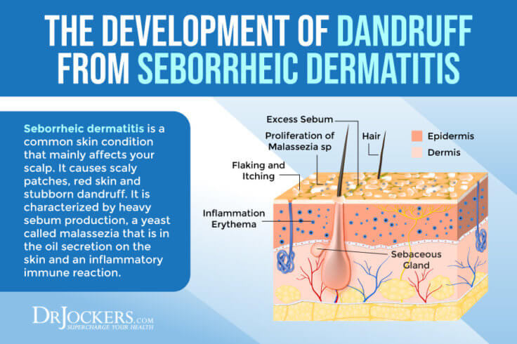 Dandruff: Root Causes and Support Strategies - DrJockers.com