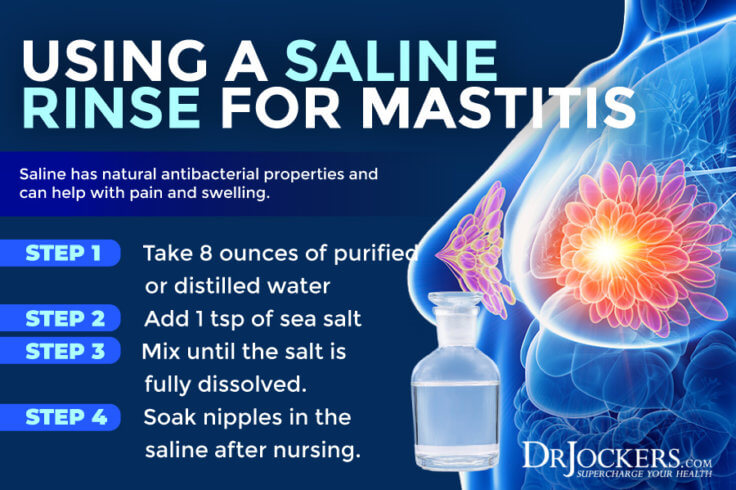Mastitis During Breastfeeding: Symptoms and Support Strategies