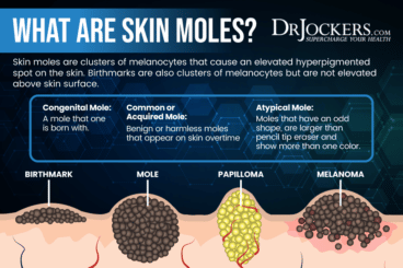 Skin Moles: Signs of Cancer and 10 Natural Removal Strategies
