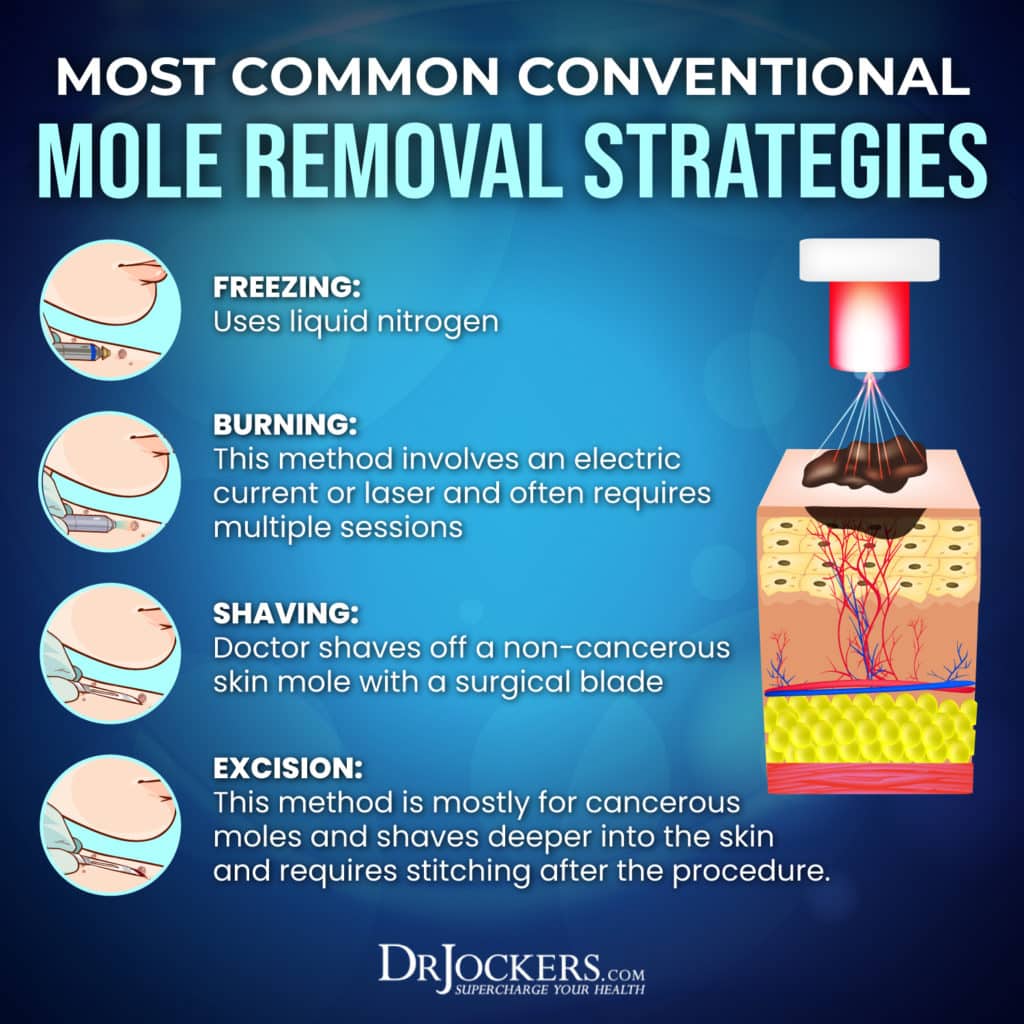 Skin Moles Signs Of Cancer And 10 Natural Removal Strategies