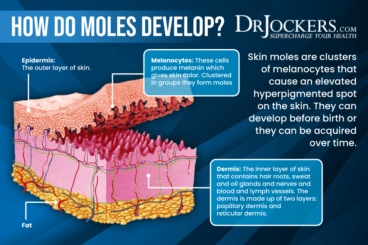 Skin Moles: Signs of Cancer and 10 Natural Removal Strategies