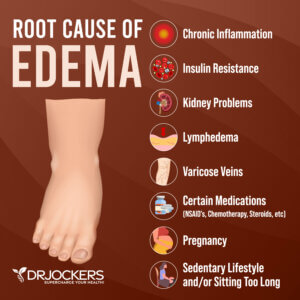 Edema: Symptoms, Causes, and Natural Support Strategies