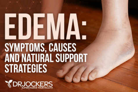 Edema: Symptoms, Causes, and Natural Support Strategies